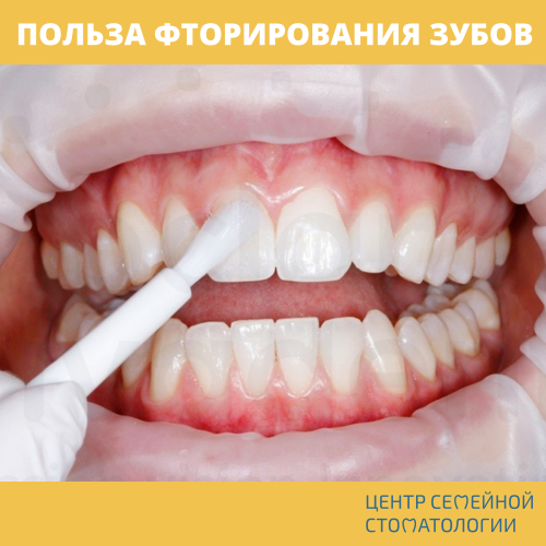 Покрытие зубов фтор-препаратами в Минске, цены на глубокое фторирование